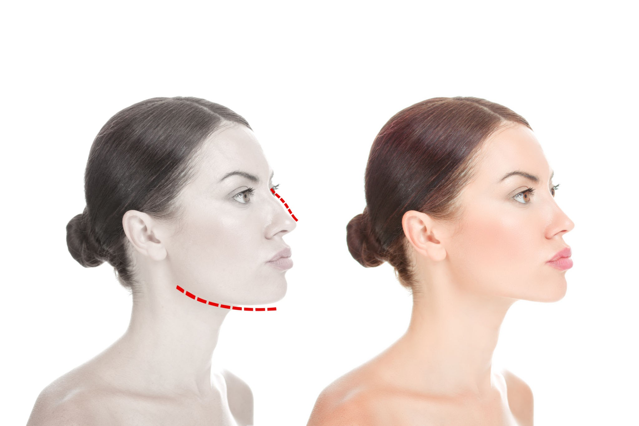 Chin Augmentation: Unveiling the Cost and Crafting Your Dream Profile ...