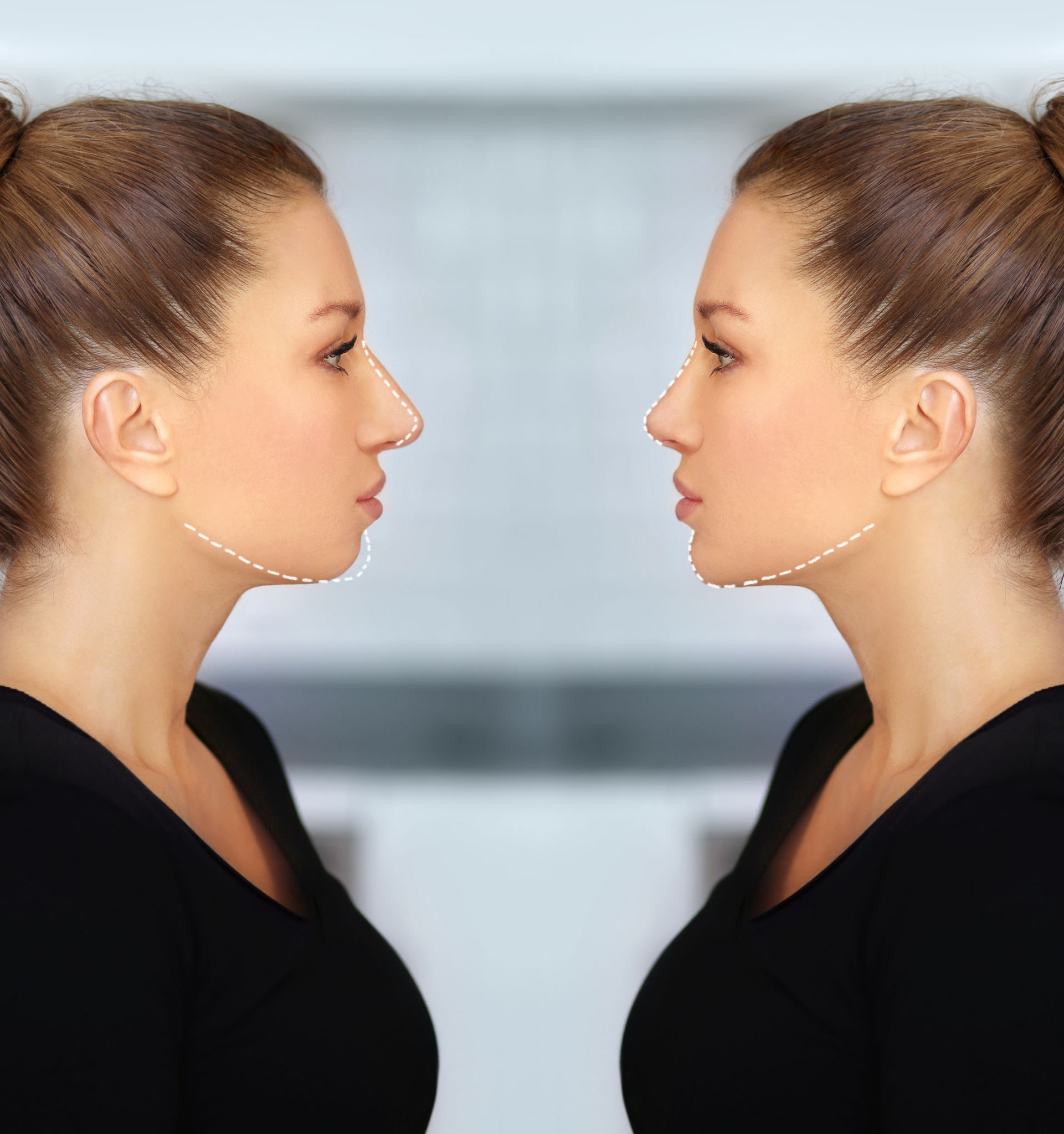 Chin Augmentation: Unveiling the Cost and Crafting Your Dream Profile ...