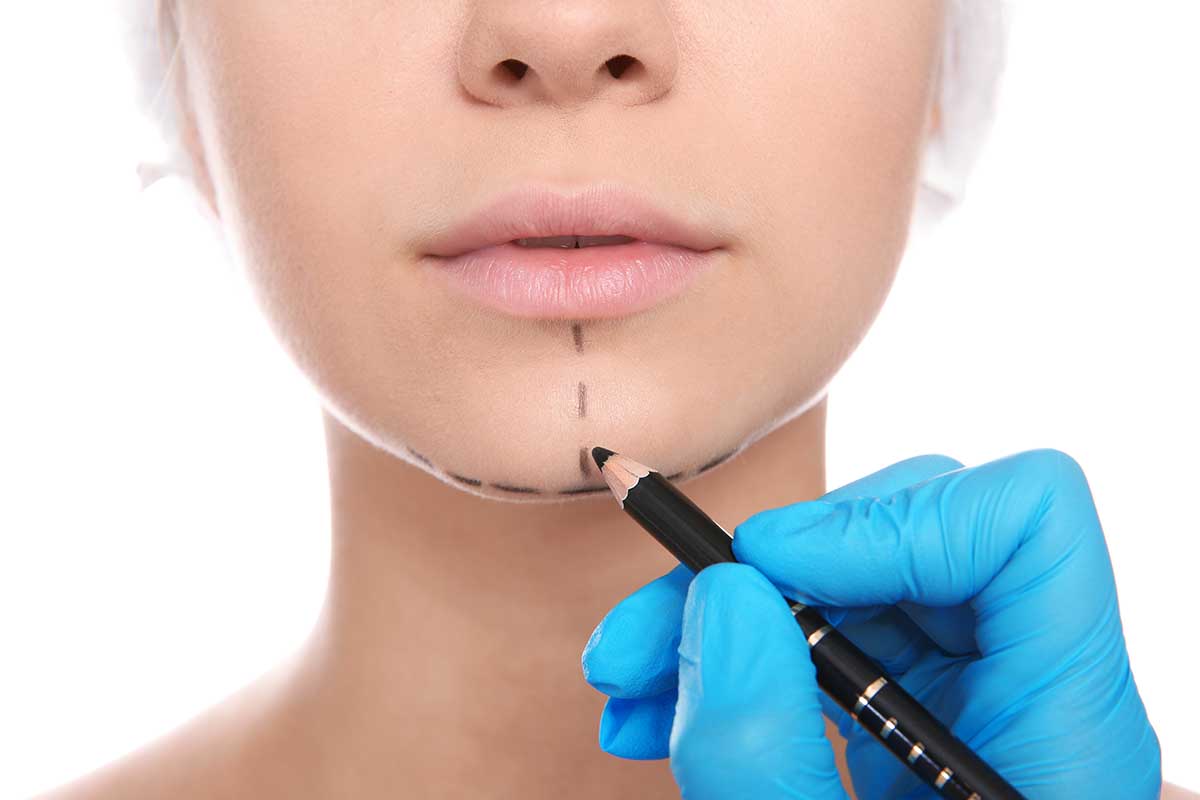 Chin Surgery in 2 Steps: Natural Look, Feminine Chin - Feminization Center