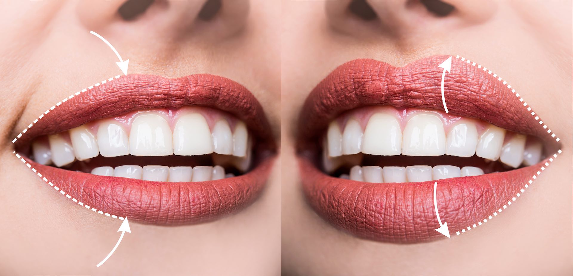 A More Youthful Lip Area: Best Methods for Upper Lip Lines ...